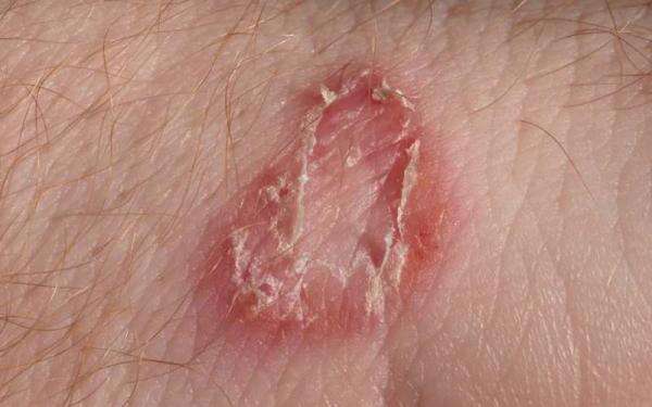 Gejala Infeksi Ringworm atau Kurap di Tubuh Manusia | News+ on RCTI+