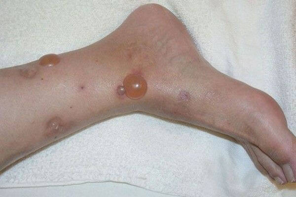 Mengenal Pemfigoid Bulosa, Penyebab, Gejala dan Cara Mengobati - News+ ...